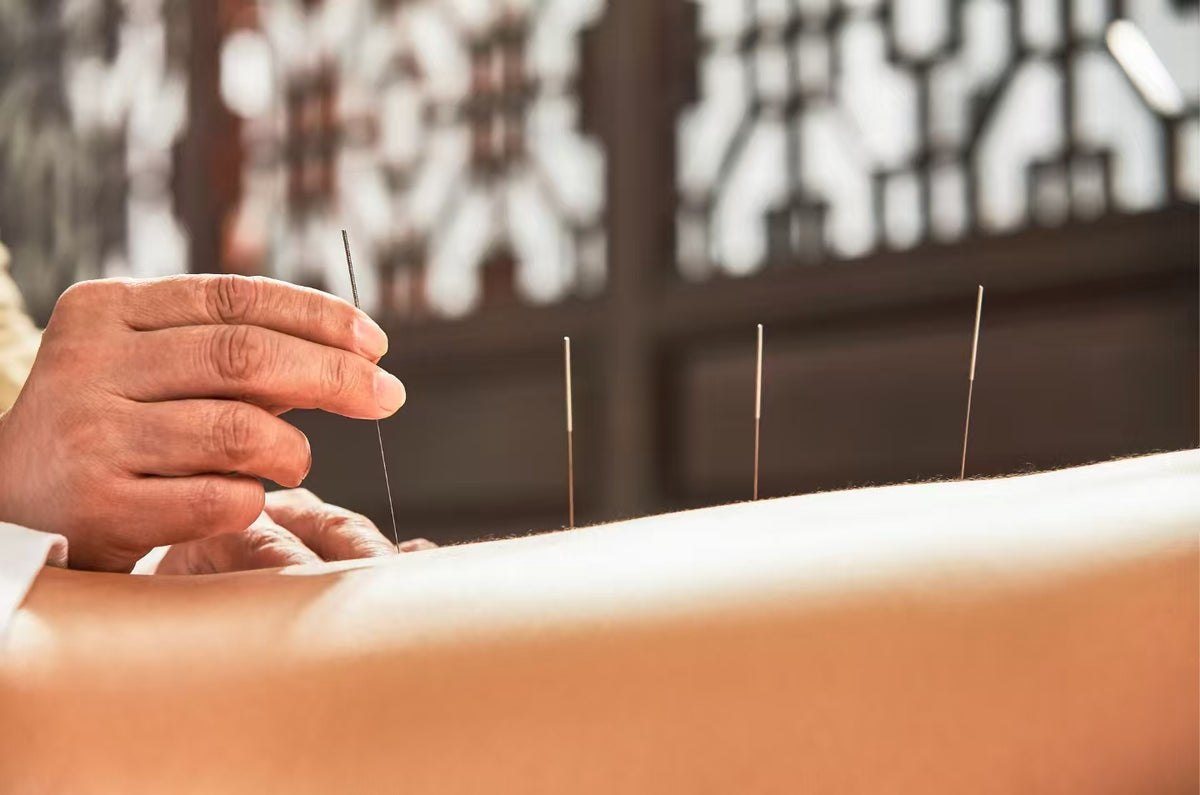 Acupuncture – TCM Relief